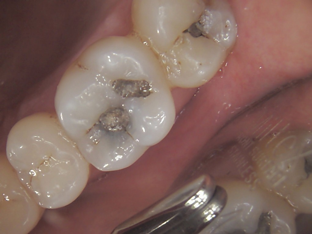Removal of leaking amalgam restorations and placement of ceramic CAD ...