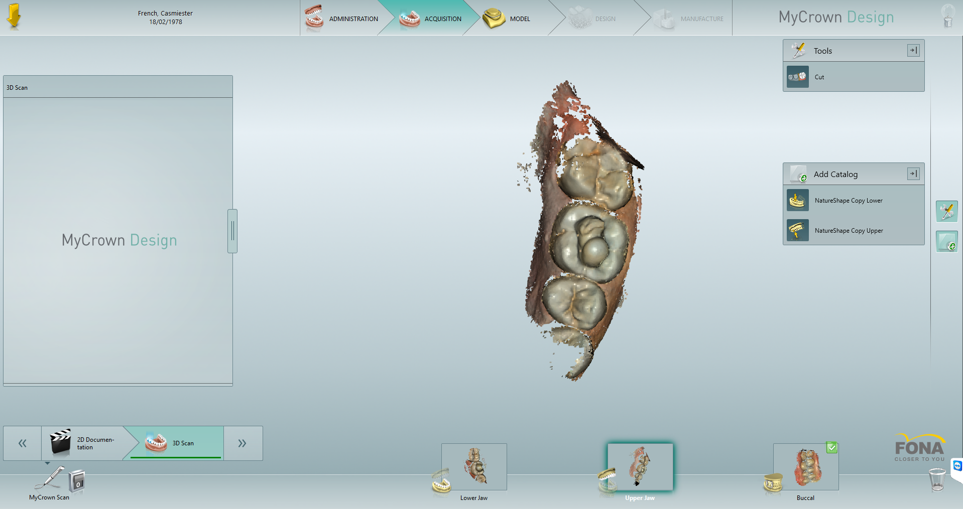 DT News - MEA - Removal of leaking amalgam restorations and placement ...