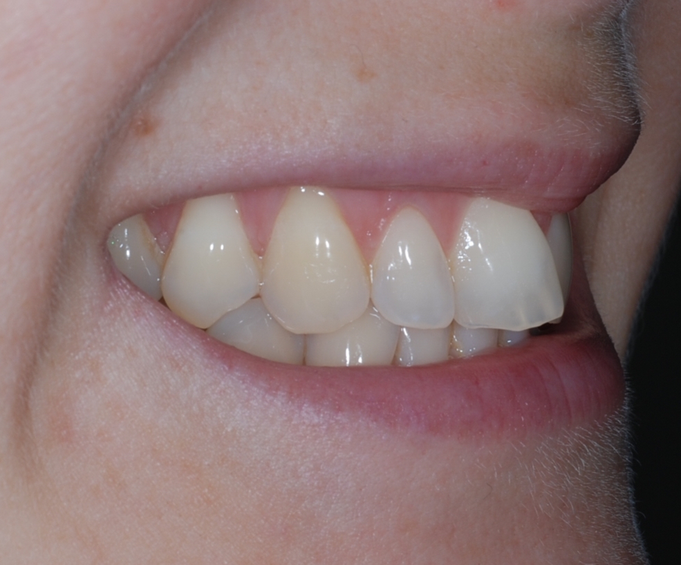 DT News - MEA - Upper Arch Alignment with the ClearSmile Inman Aligner