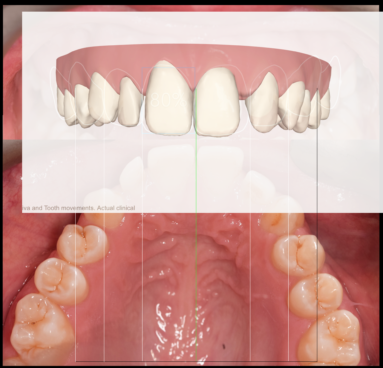 DT News - MEA - A combined digital orthodontic and restorative approach