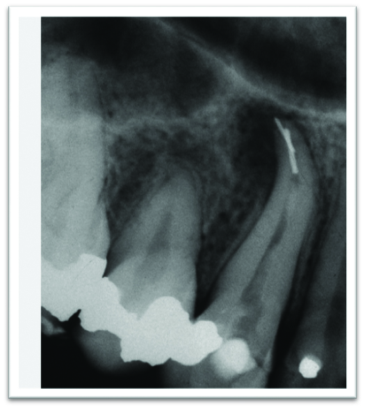 Management of Intracanal Separated Instruments