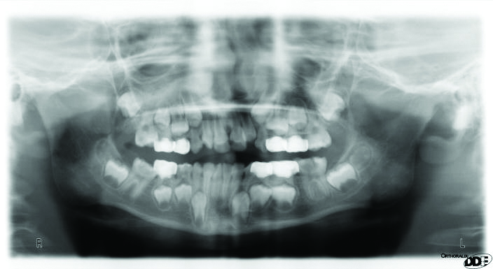 DT News - MEA - Management Of Ectopically Erupted First Permanent Molars