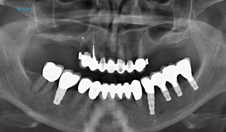 DT News - MEA - CBCT bone-densitometry for pre-surgical decision-making