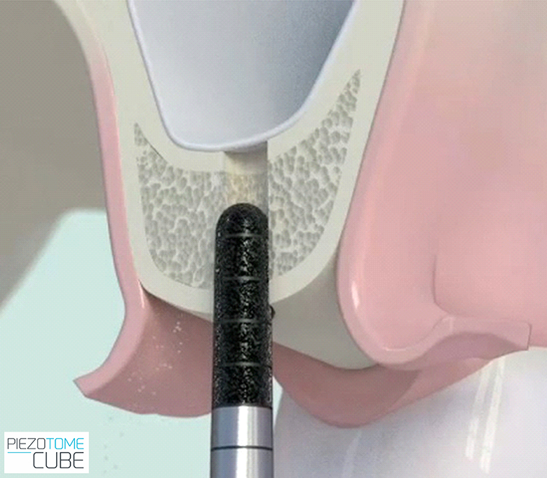 DT News - MEA - CBCT bone-densitometry for pre-surgical decision-making