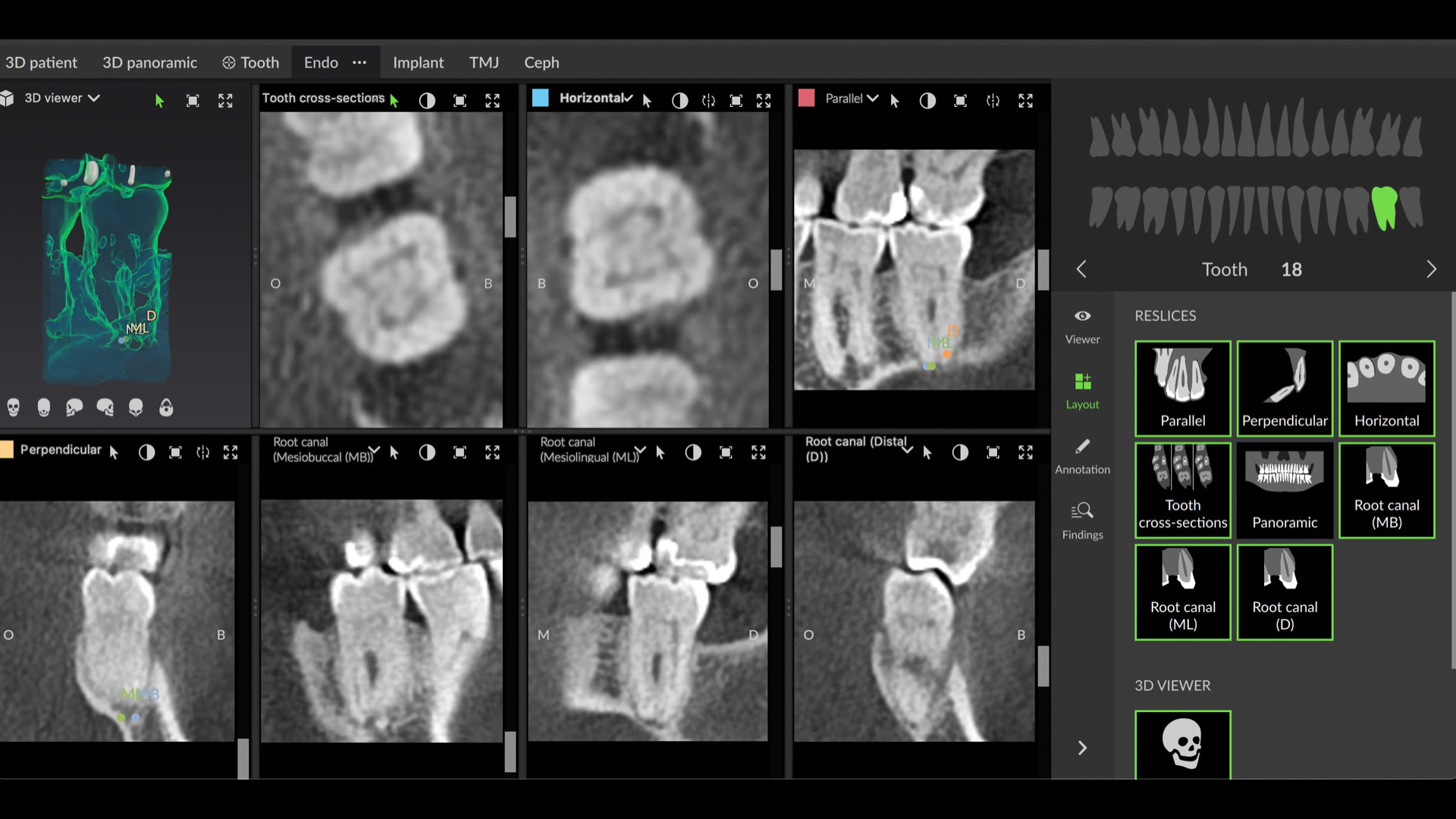 Using digital software for effective root canal therapy