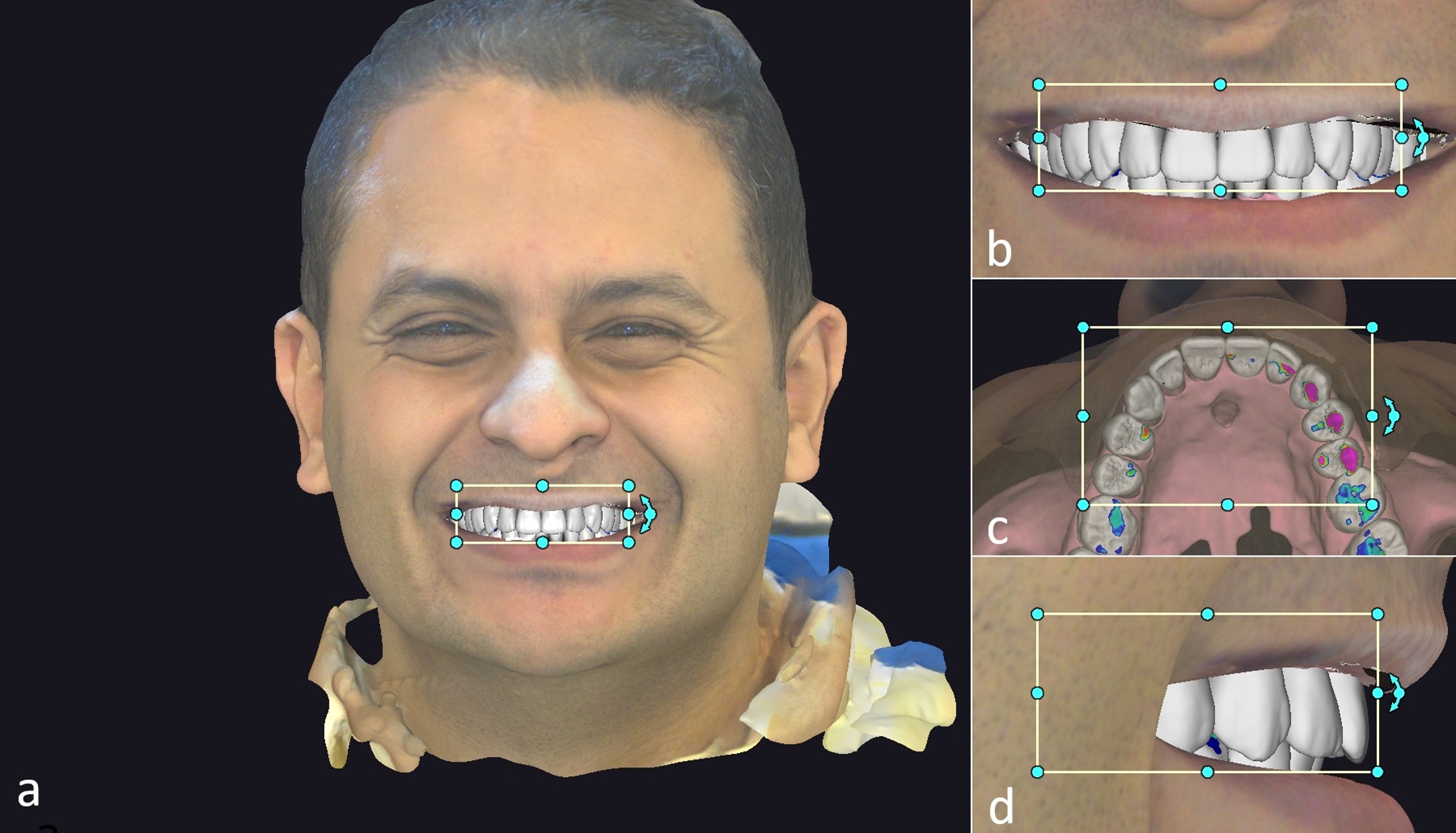 4D smile design with exocad Smile Creator software