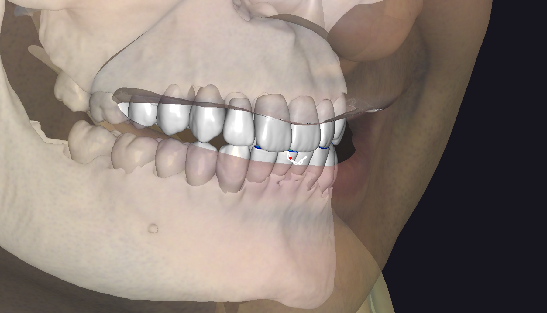4D smile design with exocad Smile Creator software