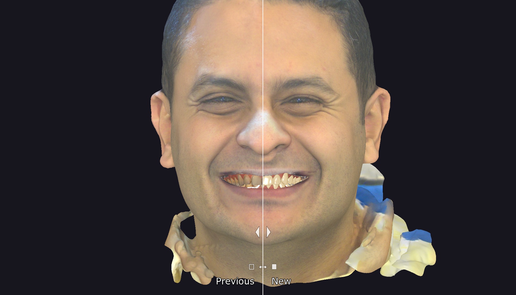 4D smile design with exocad Smile Creator software