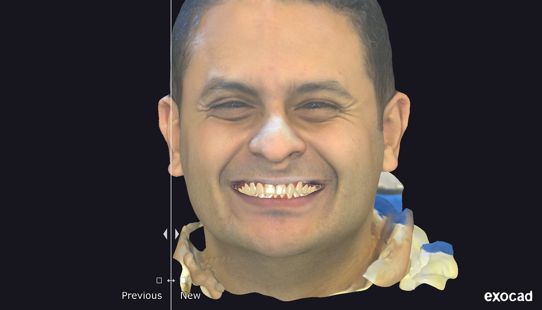 4D smile design with exocad Smile Creator software